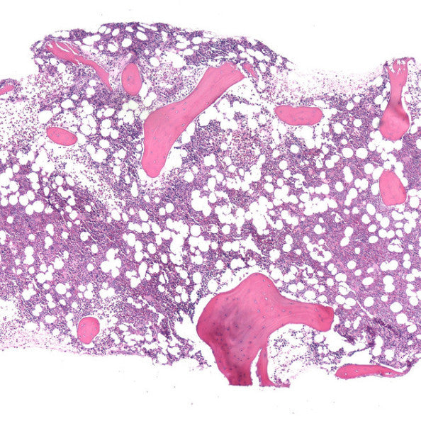 Bone Marrow Core Biopsy